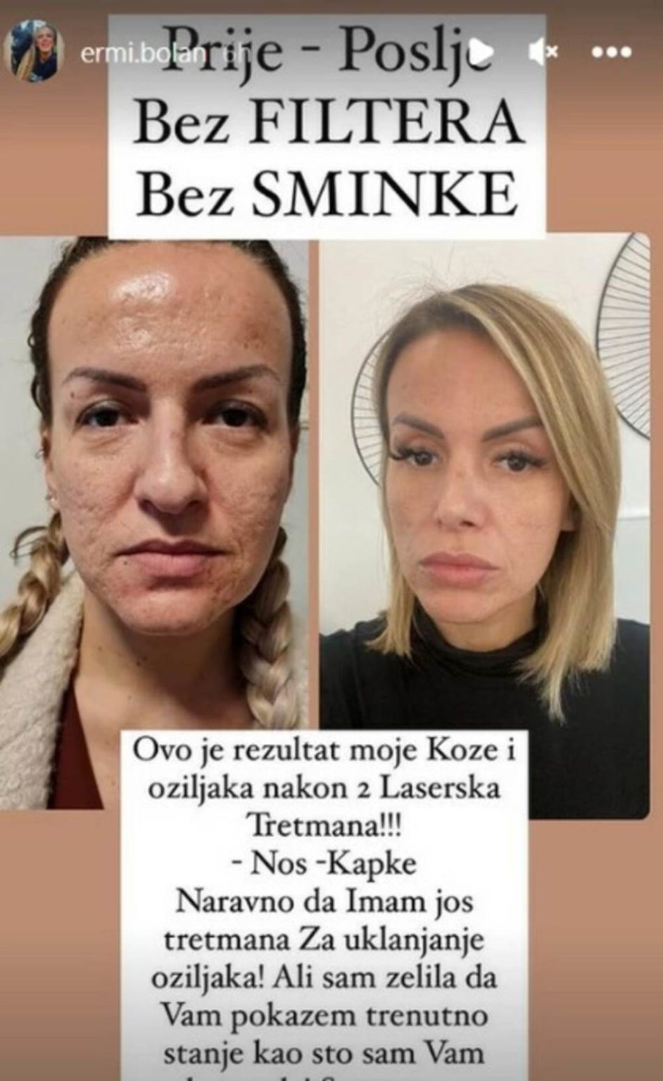 ERMINA PAŠOVIĆ PROMIJENILA LIČNI OPIS: Uložila 10.500 KM na operacije